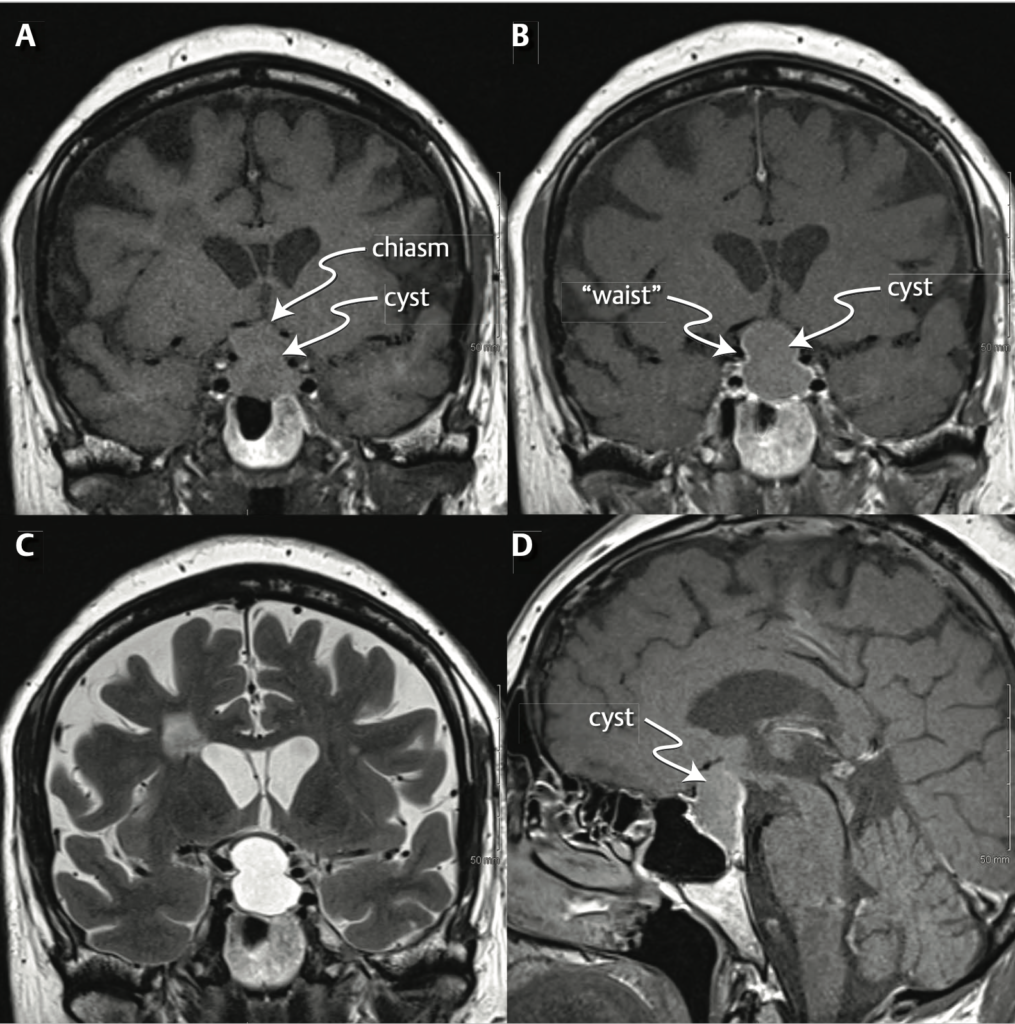 NANG KHE RATHKE - Khoa Ngoại Thần Kinh